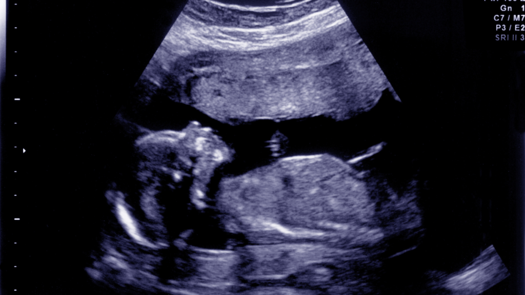 What Can Be Diagnosed with a Fetal Echocardiogram? | Dr. Nidhi Rawal